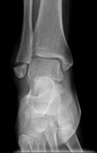 Weber A Ankle Fracture - Northern Lincolnshire and Goole NHS Foundation ...